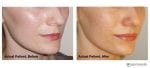 Nonsurgical cheek enhancement options for long-term results – Potomac ...