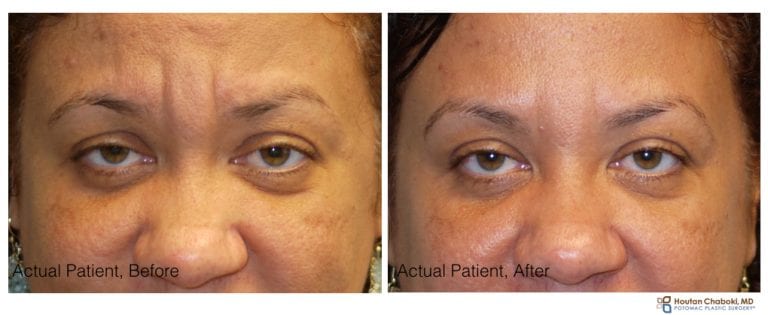 “Why do you look angry?” : Botox® Cosmetic to soften an angry ...