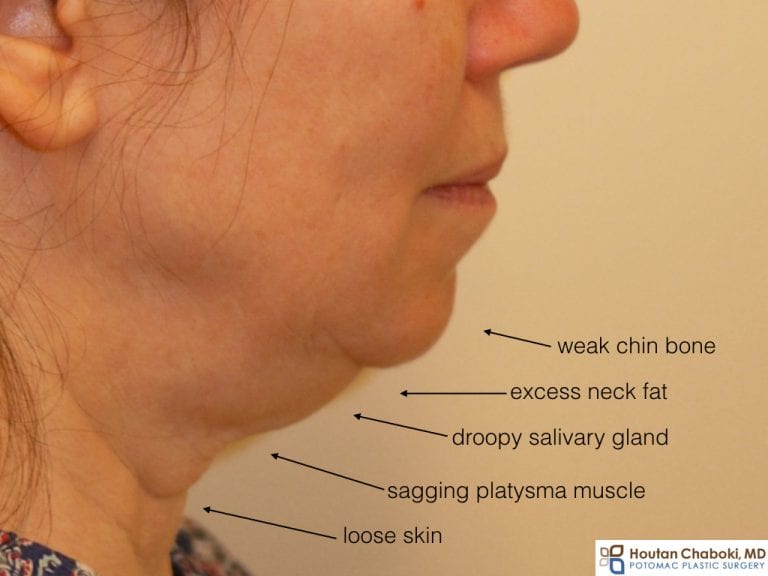 Double Chin Treatment: Which Surgery Is Best? (Before and After Photos ...