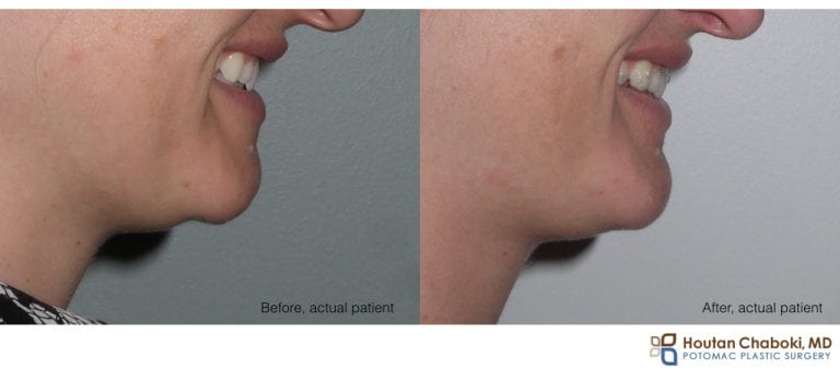 A normal smile after chin surgery with an implant – Potomac Plastic Surgery