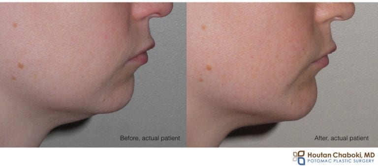 Chin augmentation with silicone: choosing the implant size – Potomac ...