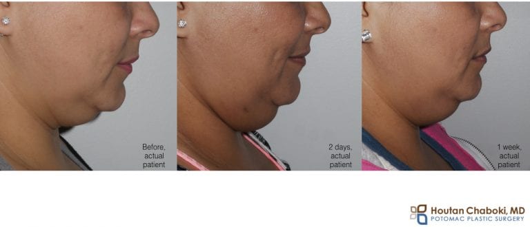 Recovery after Kybella treatment of neck fat – Potomac Plastic Surgery
