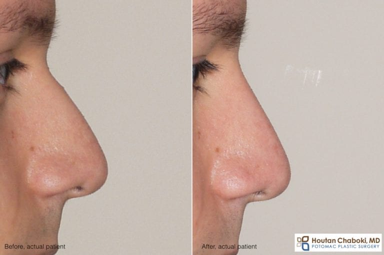 Nonsurgical rhinoplasty: a liquid lift of the nose – Potomac Plastic ...
