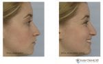Depressor Septi Muscle – Improving a Droopy Nasal Tip with Rhinoplasty ...