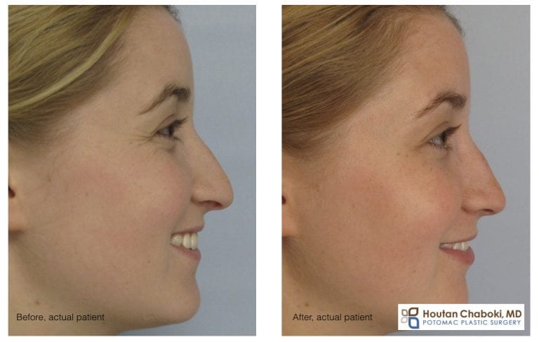 Depressor Septi Muscle – Improving a Droopy Nasal Tip with Rhinoplasty ...