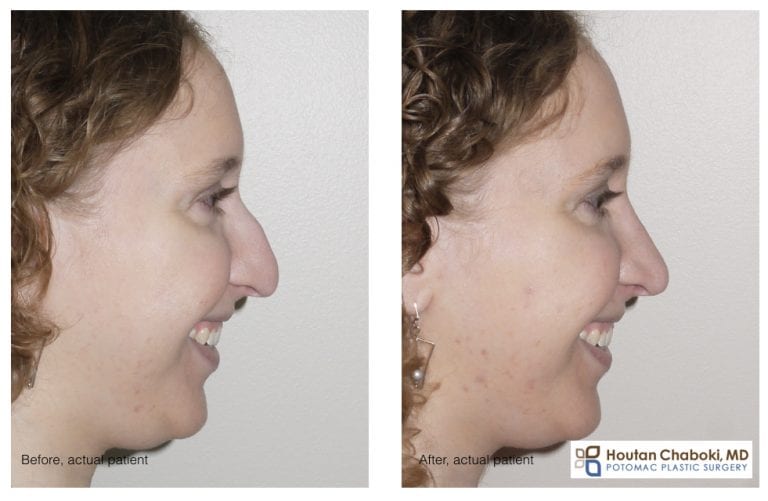 Depressor Septi Muscle – Improving a Droopy Nasal Tip with Rhinoplasty ...