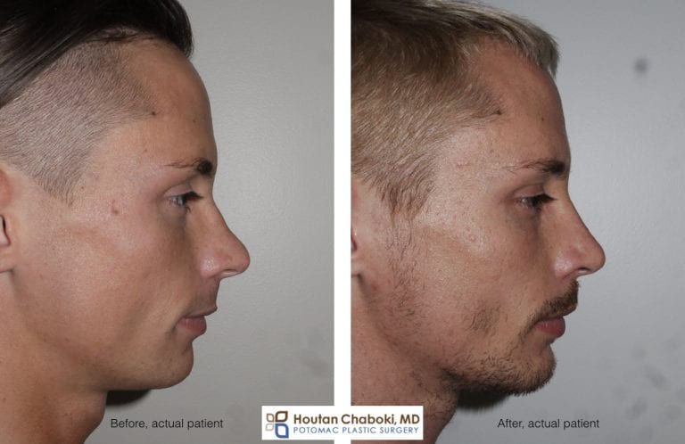 Augmenting the Root of the Nose to Improve Profile in Rhinoplasty ...