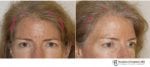 The Limited Incision Brow Lift