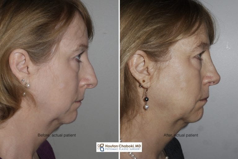 Reshaping the Nasal Bone in Rhinoplasty – Potomac Plastic Surgery