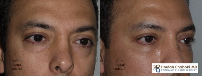 Improve Lower Eyelid & Cheek junction with surgery or filler