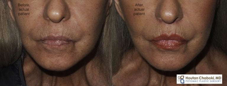 Upper lip lift surgery is Better than injections for a Long Lip