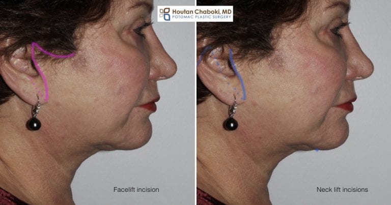 Neck Lift Vs Facelift Cosmetic Surgery Potomac Plastic Surgery