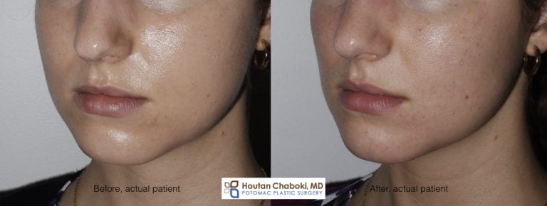Slimming the Face with Cheek Fat Reduction