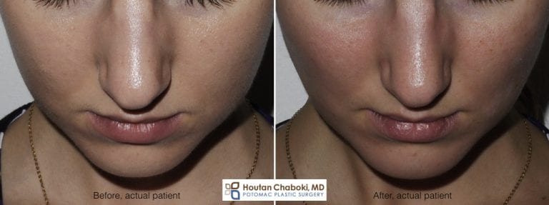 Slimming the Face with Cheek Fat Reduction