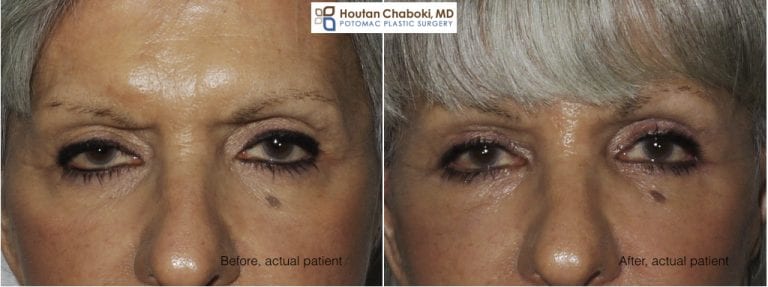 Incisions and Approaches in Lower Eyelid Surgery – Potomac Plastic Surgery