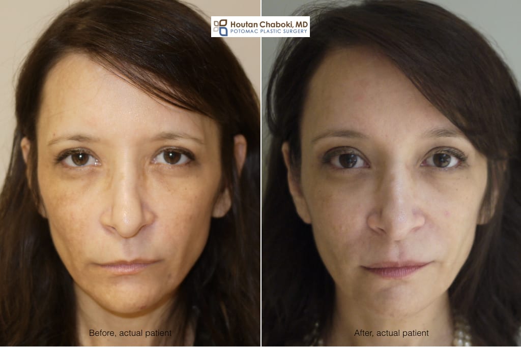 Will the iPhone® X recognize you after Plastic Surgery? – Potomac ...