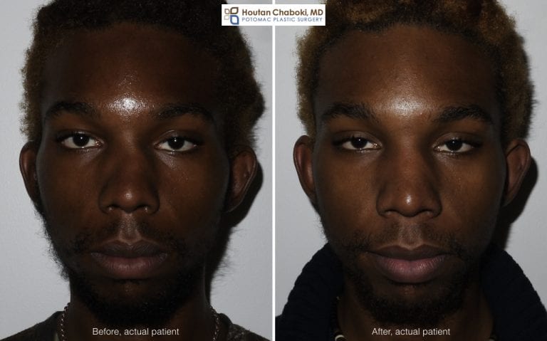 Broken Nose Repair Restoring And Improving Nasal Form