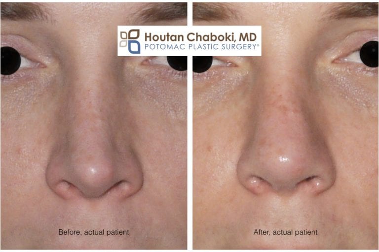 Open vs. Closed Rhinoplasty – Which is better? - Potomac Plastic Surgery