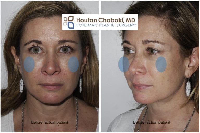 Cheek Augmentation with Fillers