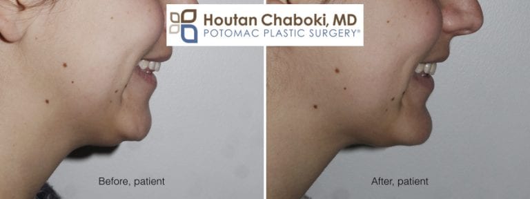 Relaxing a Dimpled Chin Muscle