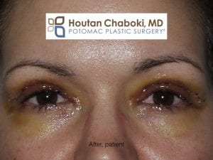 Early Recovery after Upper Eyelid Surgery (Blepharoplasty)