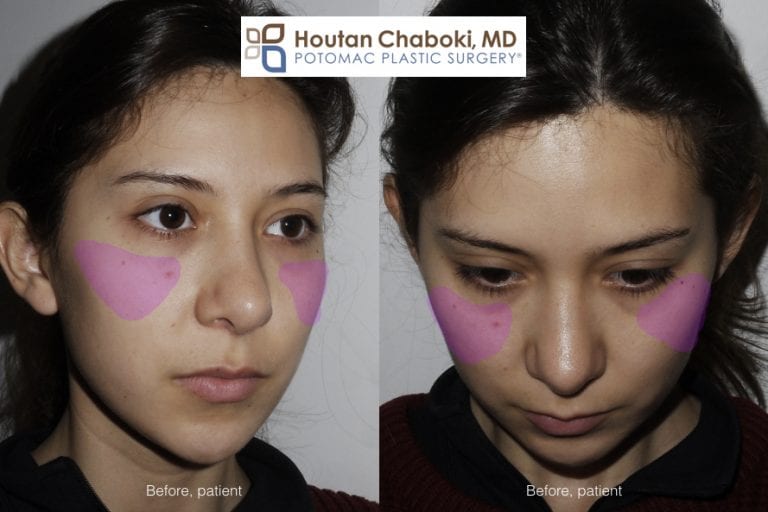 Fill Flat Cheeks with Facial Fillers