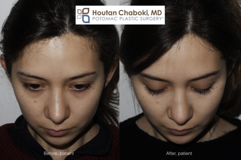 Fill Flat Cheeks with Facial Fillers