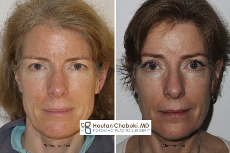 The Frontalis Muscle in Plastic Surgery