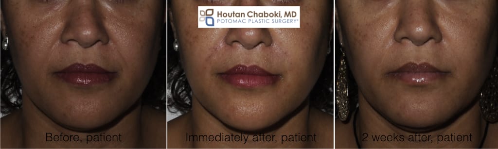 Softening Smile Lines with Facial Fillers