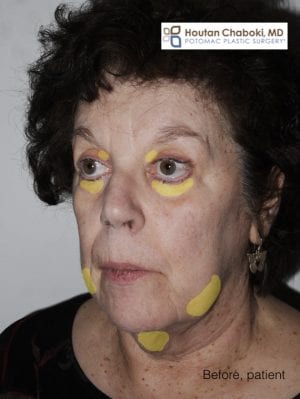 Adding and Removing Fat from the Face and Neck