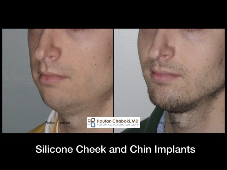 Silicone Cheek Implant Surgery