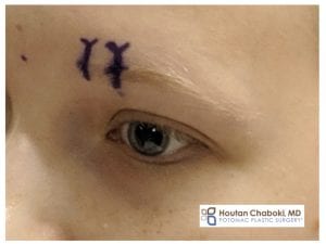 Migraine Surgery for Chronic Headaches
