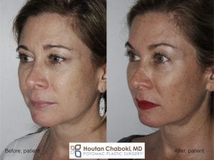 Fixing Flat Cheeks with Plastic Surgery