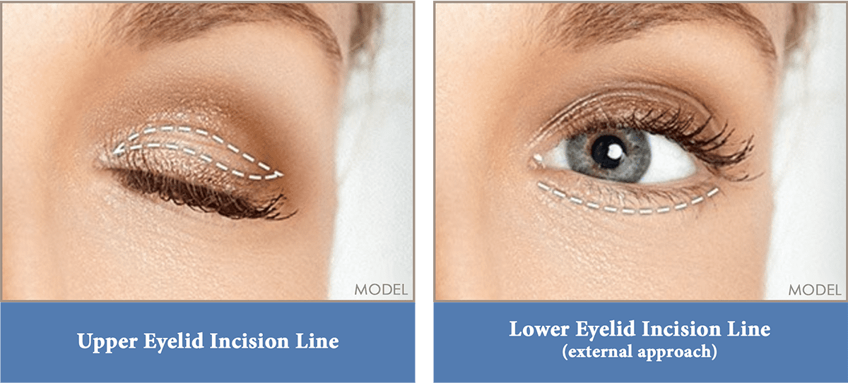 Blepharoplasty (Eyelid Surgery) for Washington, DC & Arlington, VA ...