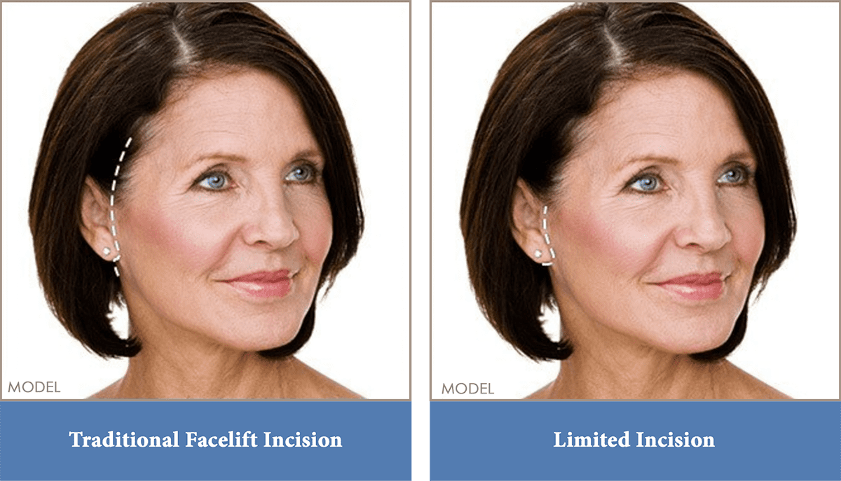 Facelift & Mini Facelift Washington, DC, & Arlington, VA | Potomac ...