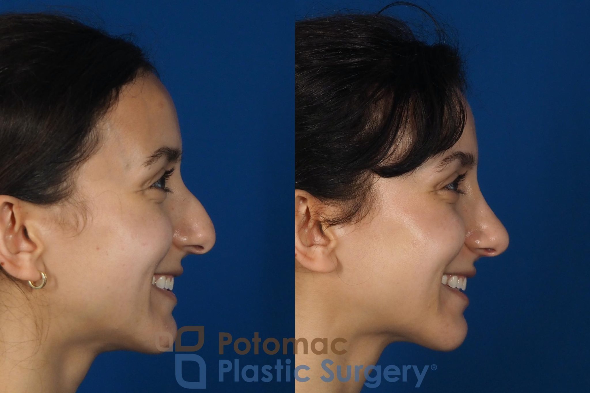 Bump Reduction in Rhinoplasty – Potomac Plastic Surgery
