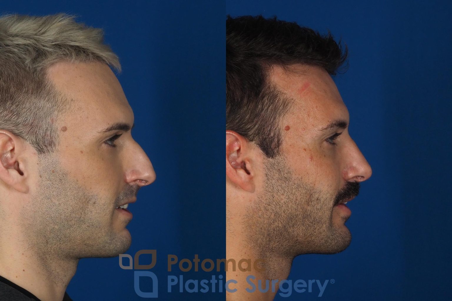 Bump Reduction in Rhinoplasty – Potomac Plastic Surgery