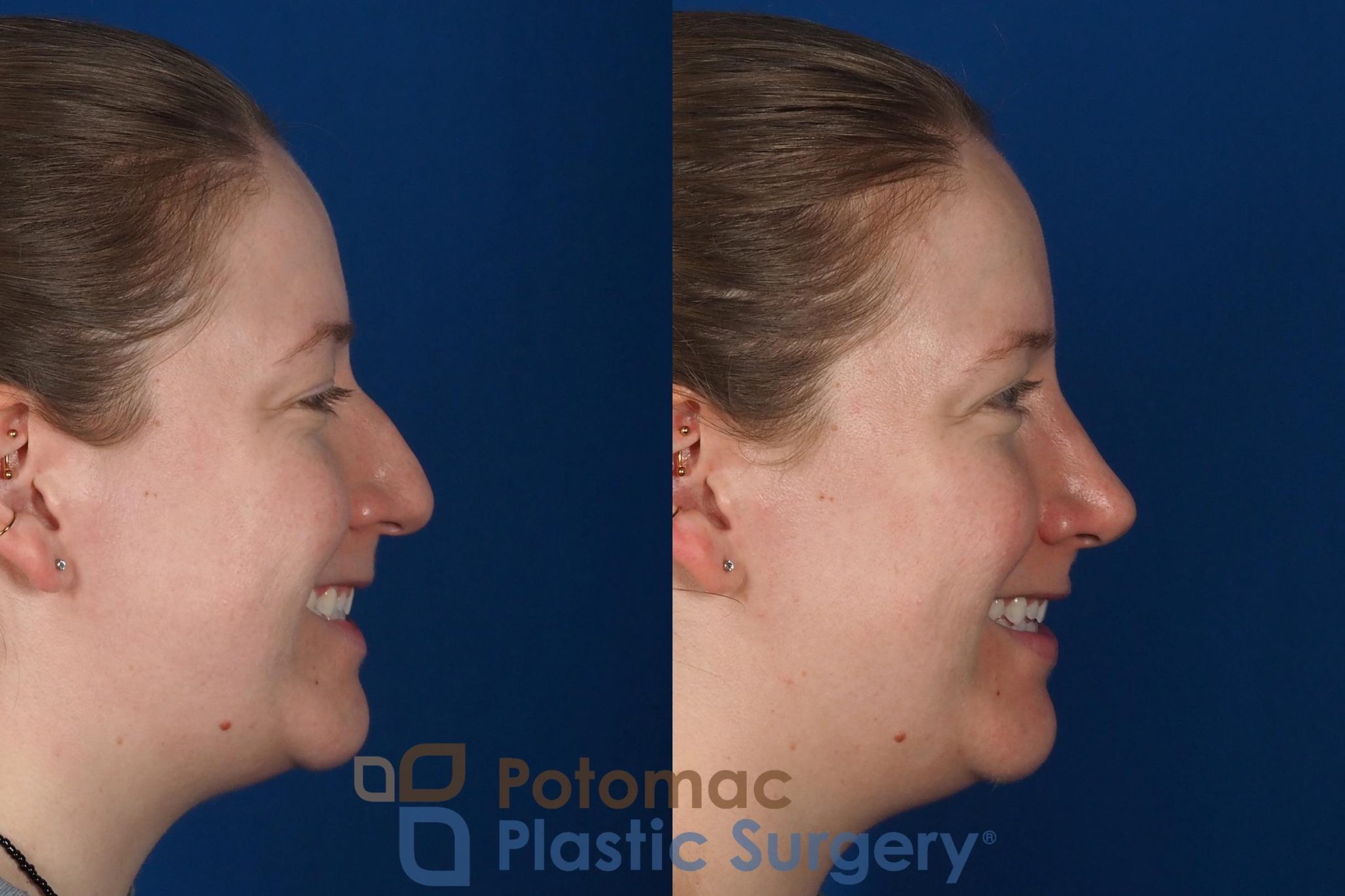 Bump Reduction in Rhinoplasty – Potomac Plastic Surgery