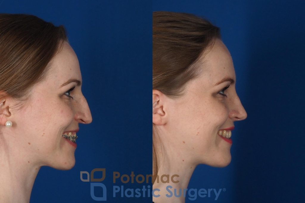Bump Reduction in Rhinoplasty – Potomac Plastic Surgery