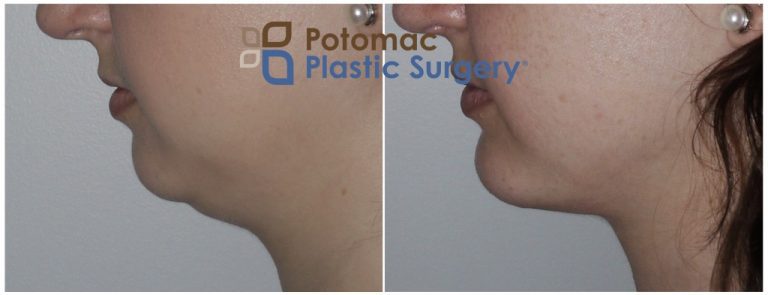 Deep Neck Lift Surgery